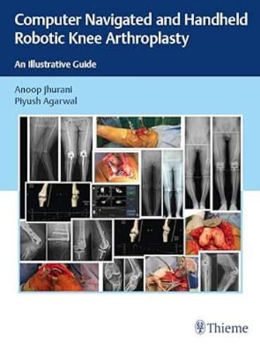 Computer Navigated and Handheld Robotic Knee Arthroplasty pdf – medPDF